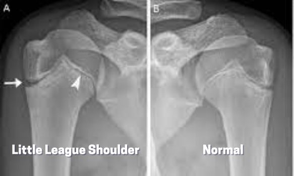 Little League Shoulder: What it is and How to Treat it